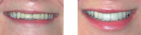 Smile Makeover – Axminster Dental Practice