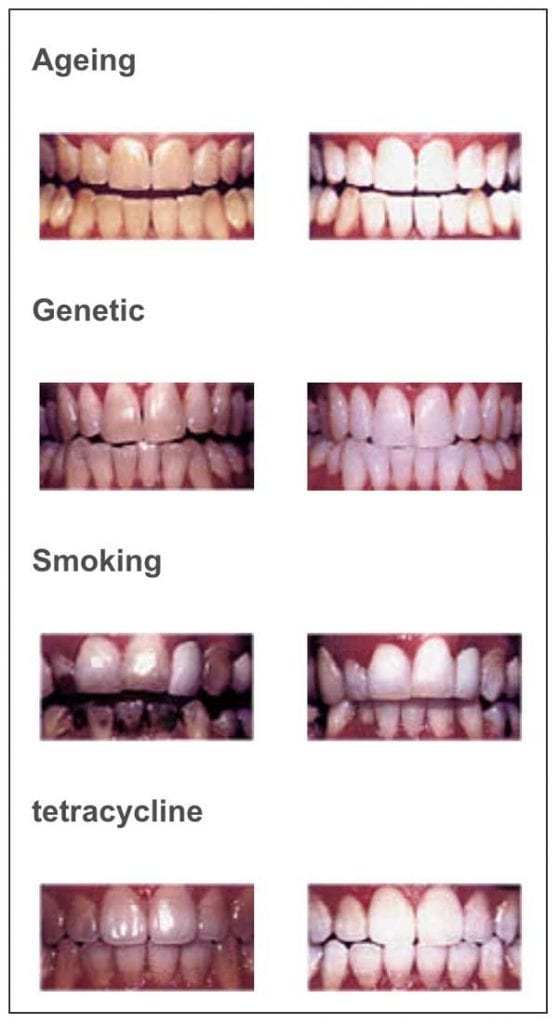 Tooth Whitening – Axminster Dental Practice